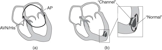 [PDF] Understanding Intracardiac EGMs by Fred M. Kusumoto ...