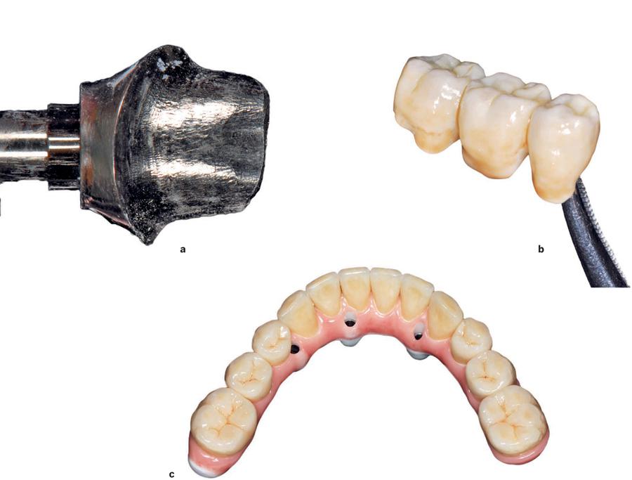 [PDF] Zero Bone Loss Concepts by Tomas Linkevičius eBook | Perlego