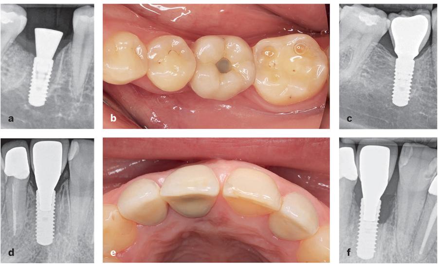 [PDF] Zero Bone Loss Concepts by Tomas Linkevičius eBook | Perlego