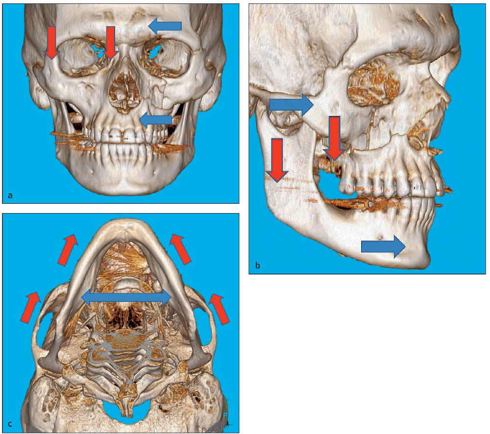 [PDF] Surgical Management of Maxillofacial Fractures by Yoh Sawatari ...