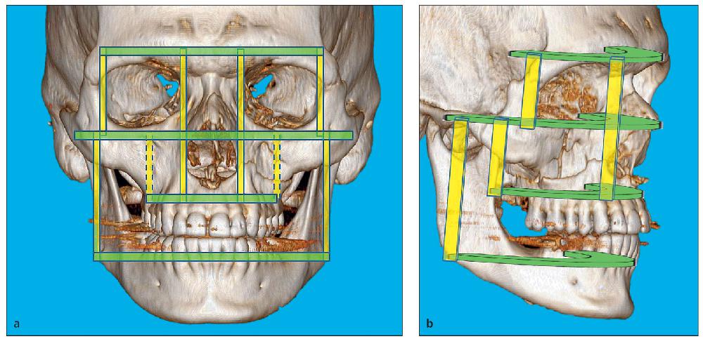 [PDF] Surgical Management of Maxillofacial Fractures by Yoh Sawatari ...