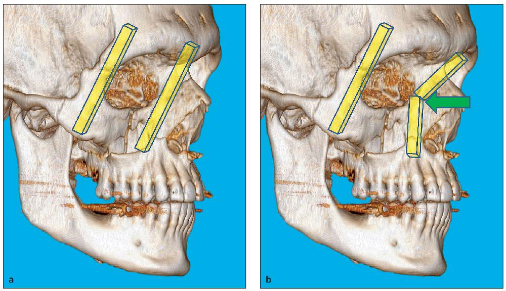 [PDF] Surgical Management of Maxillofacial Fractures by Yoh Sawatari ...