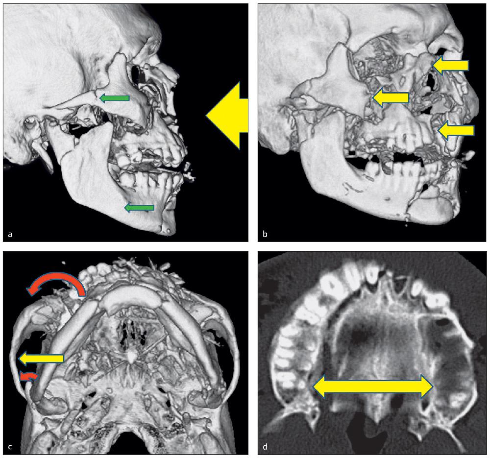 [PDF] Surgical Management of Maxillofacial Fractures by Yoh Sawatari ...