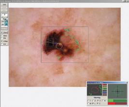 [PDF] Dermatoscopy in Clinical Practice by Giuseppe Micali eBook | Perlego