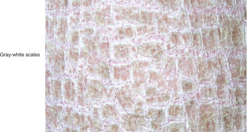 [PDF] Atlas of Dermatopathology by Günter Burg eBook | Perlego